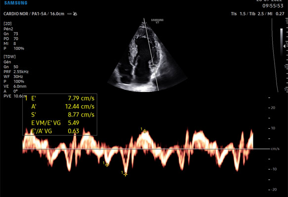 Cardiac ultrasound - Center for Cardiology and Cardiovascular ...