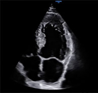 Écho-doppler TSA - centre de cardiologie et de réadaptation
